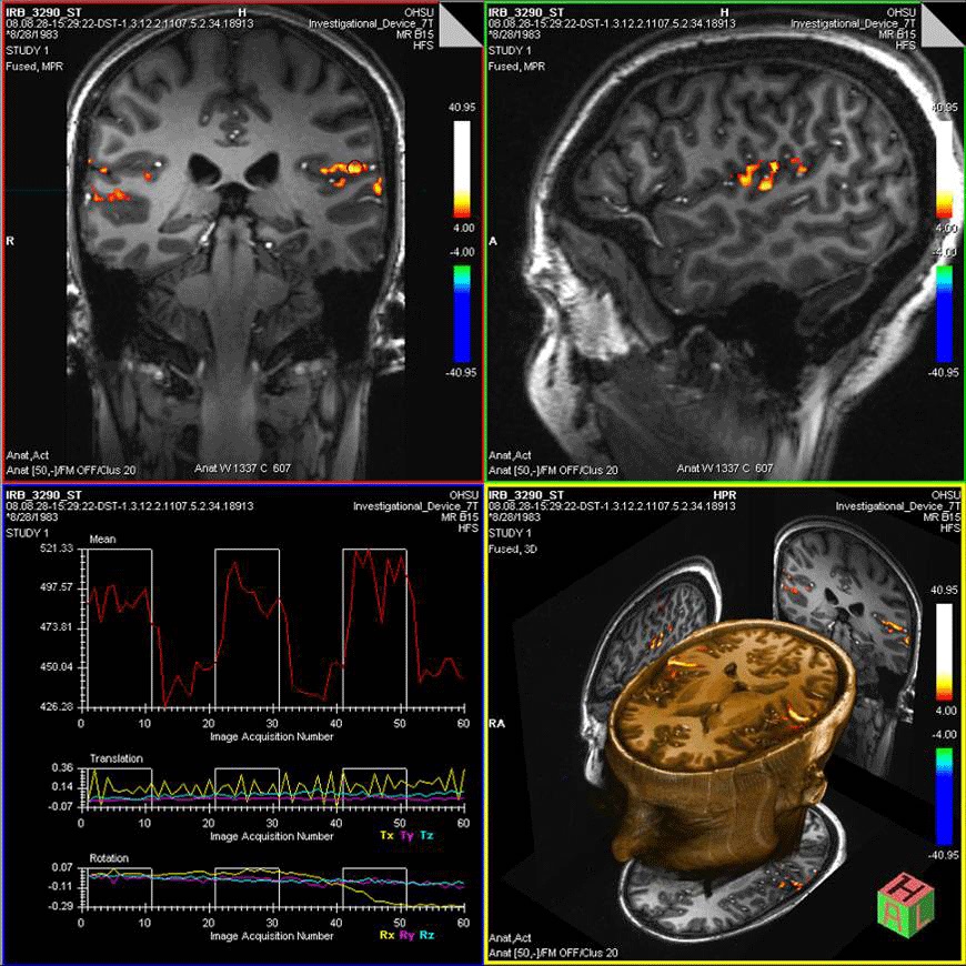 Auditory 7T fMRI Study | OHSU