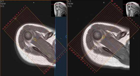 MR Shoulder Arthrogram Protocol | OHSU